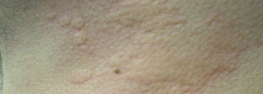 What Are The Symptoms of An Asbestos Rash? - The Law Offices of ...